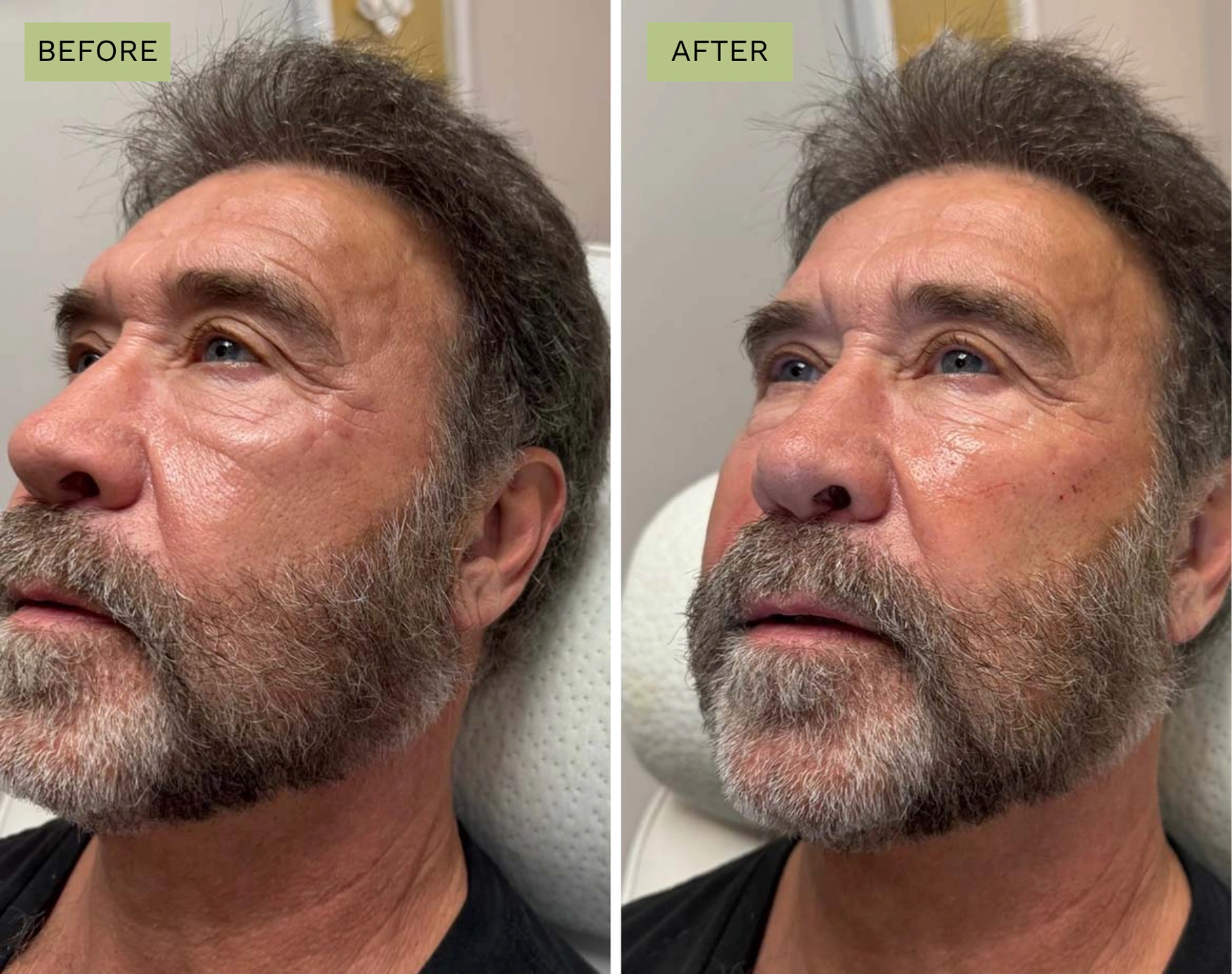 Elite Cheeks in Sarasota | Elite Medical Spa