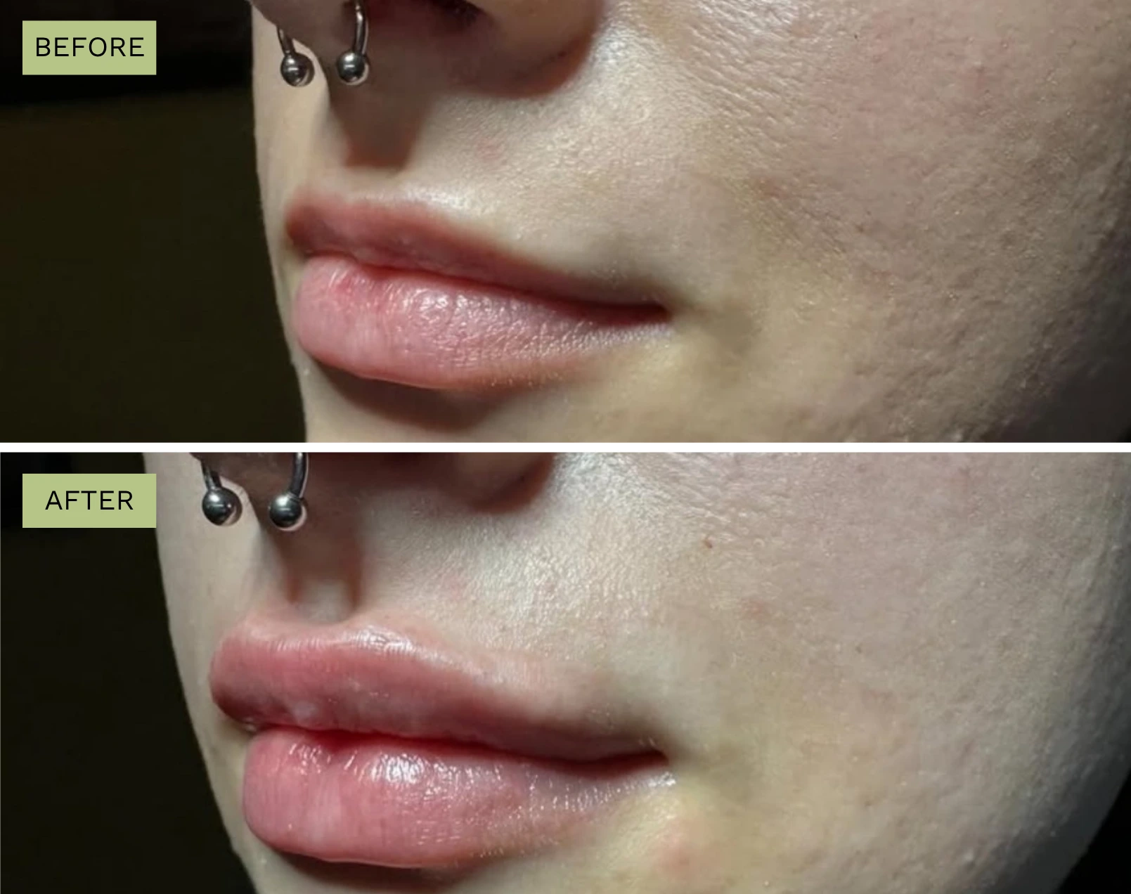 Elite Lips in Sarasota | Elite Medical Spa