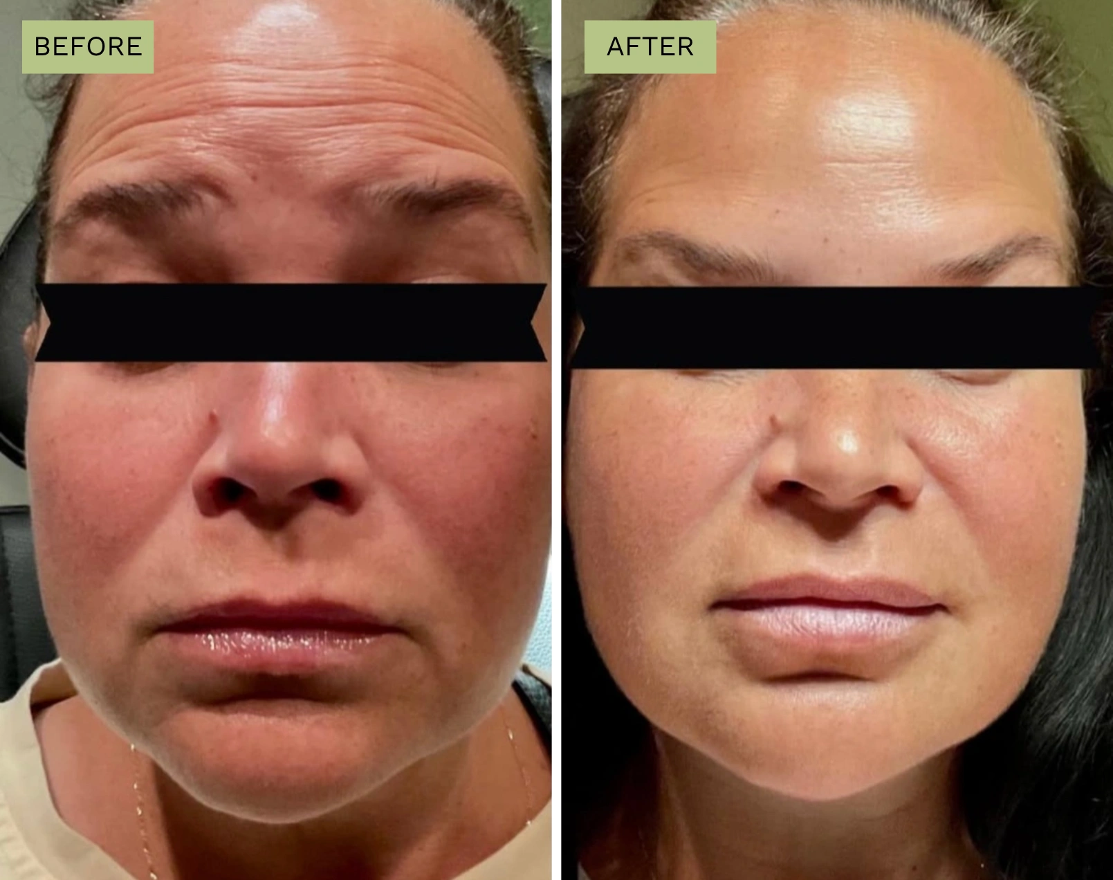 BoTox Treatment in Sarasota | Elite Medical Spa