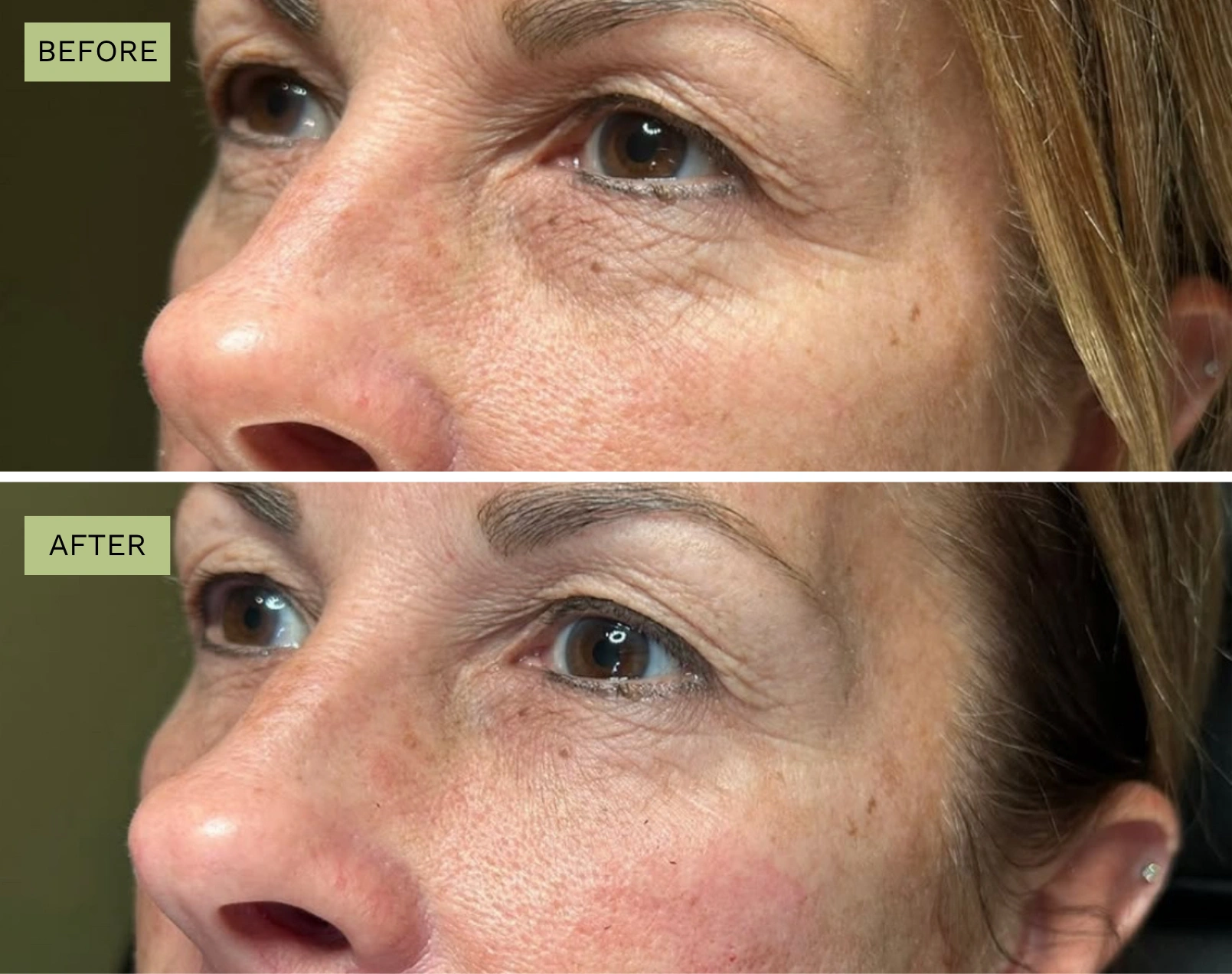 Elite Under Eyes in Sarasota | Elite Medical Spa
